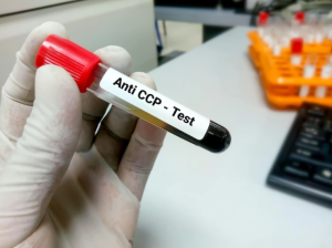 ANTI CCP (ACCP)