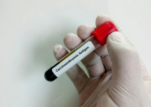 CARCINO EMBRYONIC ANTIGEN (CEA)